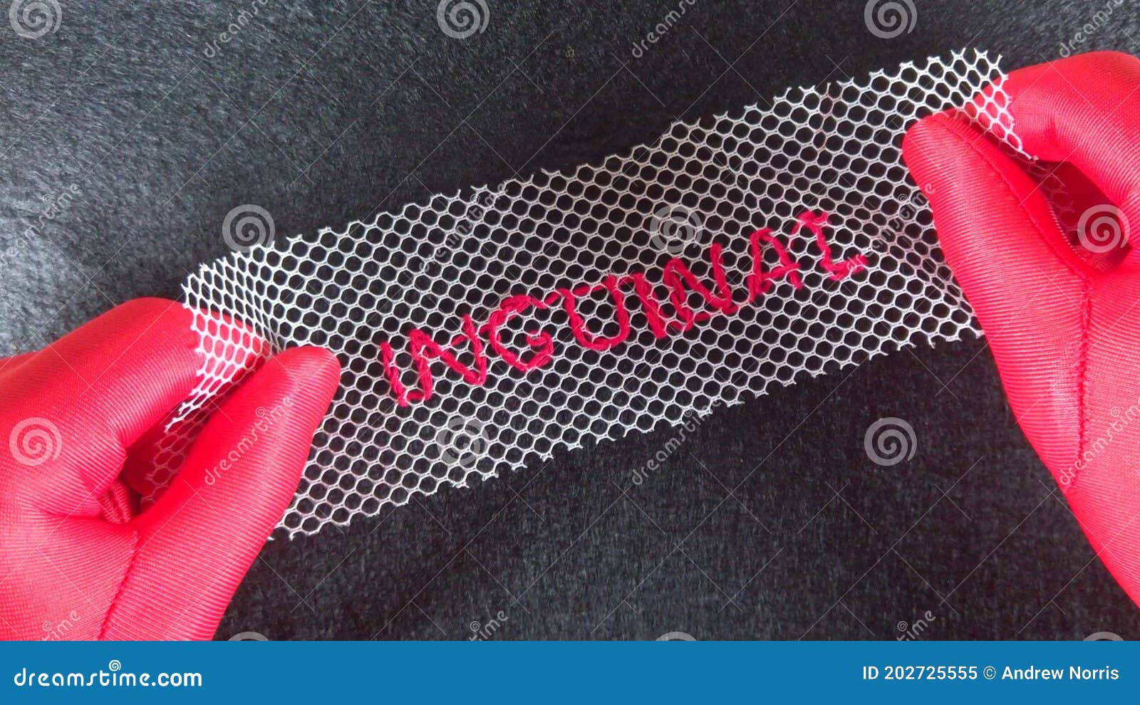 Inguinal Mesh Issues stock video. Video of procedure - 202725555