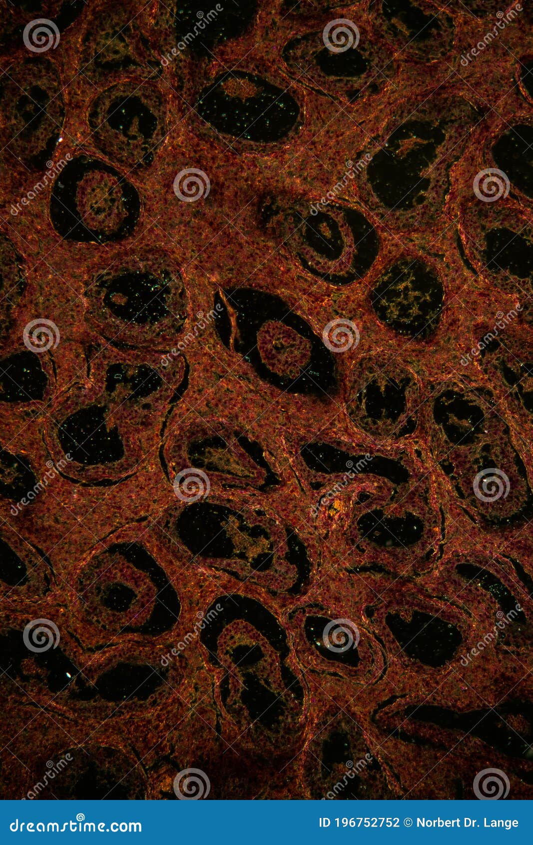 Inguinal Testicles Gonadically Diseased Tissue Royalty-Free Stock Photo ...