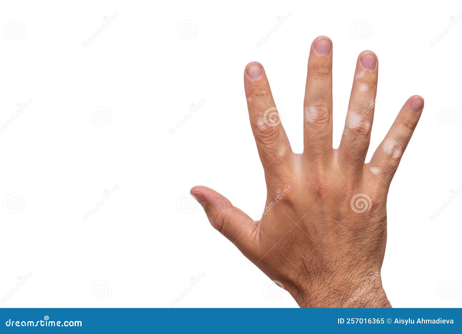 The Initial Stage of Vitiligo Skin Disease Stock Image - Image of ...