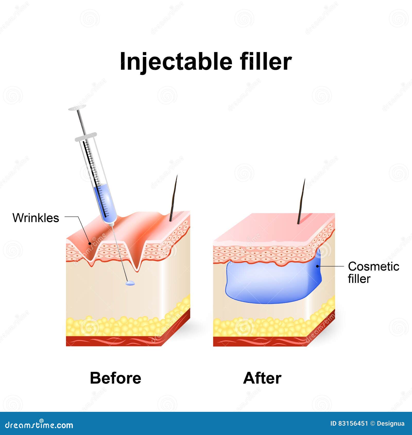 Injectables Cartoons, Illustrations & Vector Stock Images - 30 Pictures ...