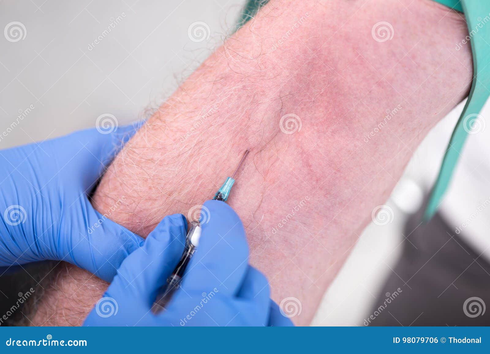 Injection of a Catheter in the Arm Stock Photo - Image of health ...