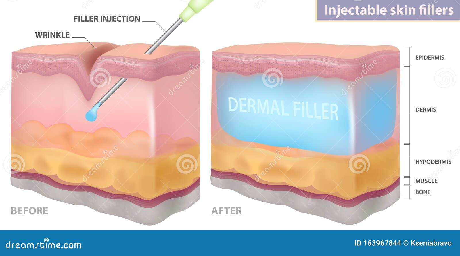 Injection Filler Injection Under the Skin, Vector Illustration Stock ...