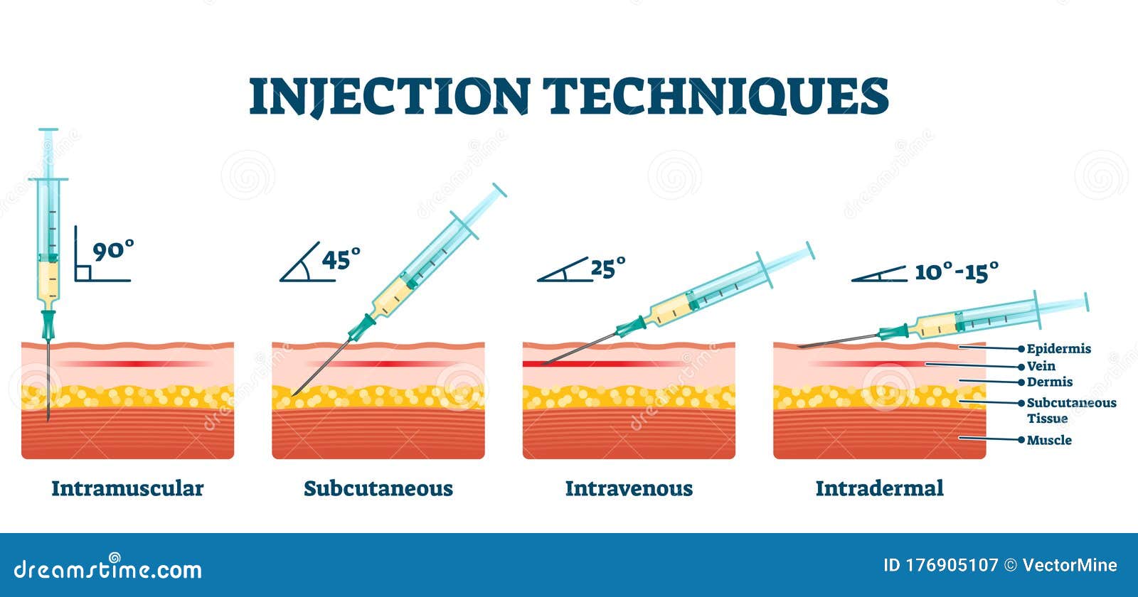 Diagram Showing Intramuscular Injection Illustration - vrogue.co Diagram Showing Intramuscular Injection Illustration - vrogue.co