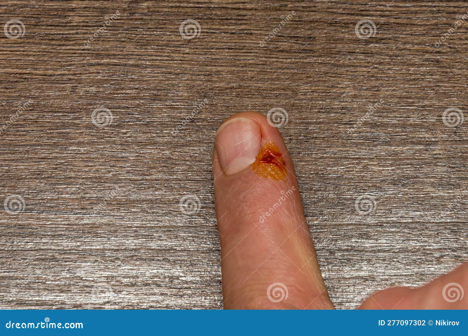 Injured cut finger on hand stock photo. Image of fingers - 277097302