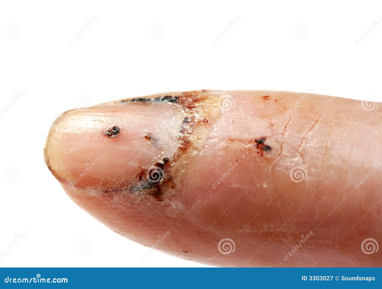 Injured Finger stock image. Image of finger, hospitalisation - 3303027