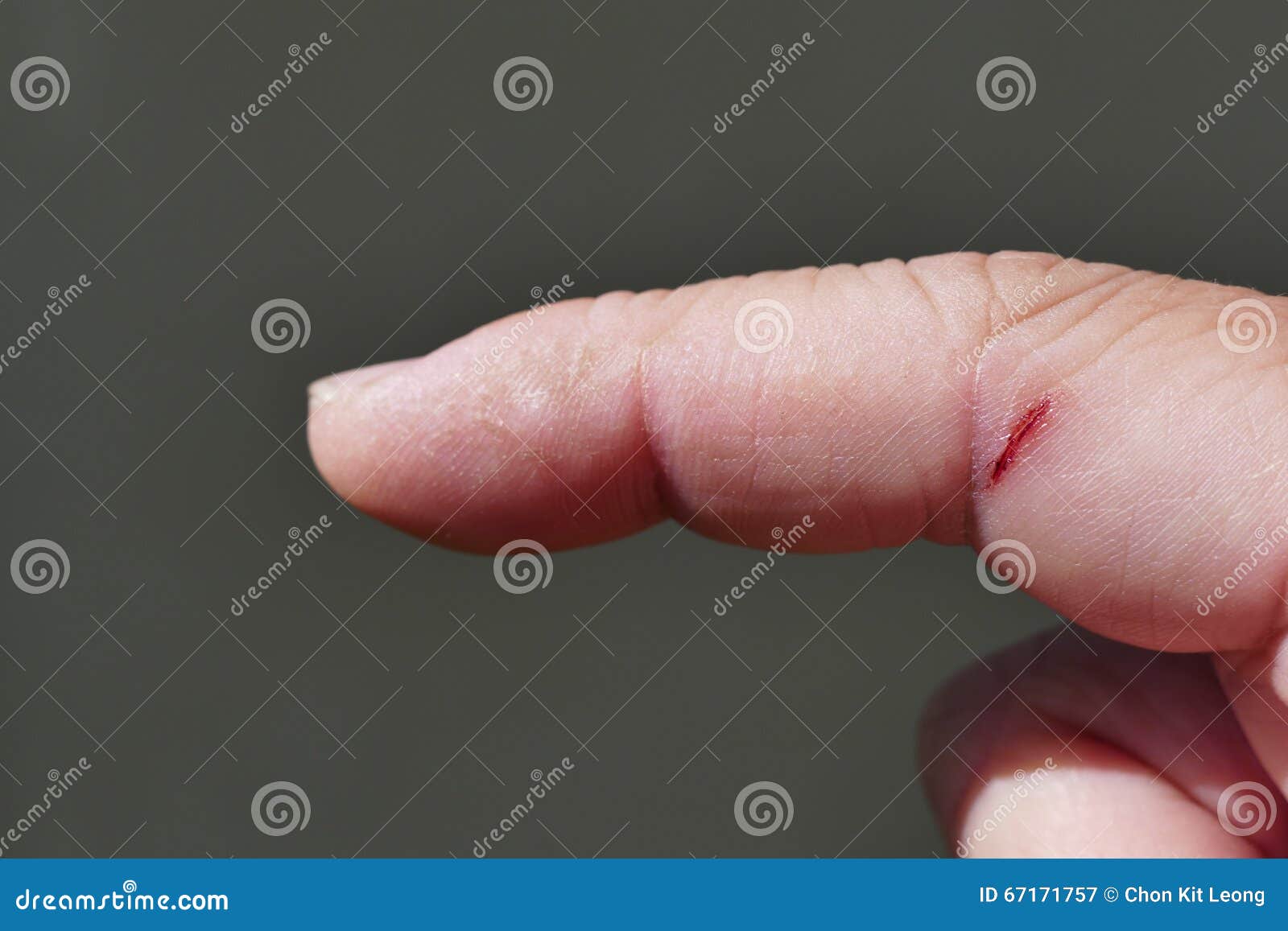 Injured Finger with Bleeding Open Cut Stock Image - Image of close ...