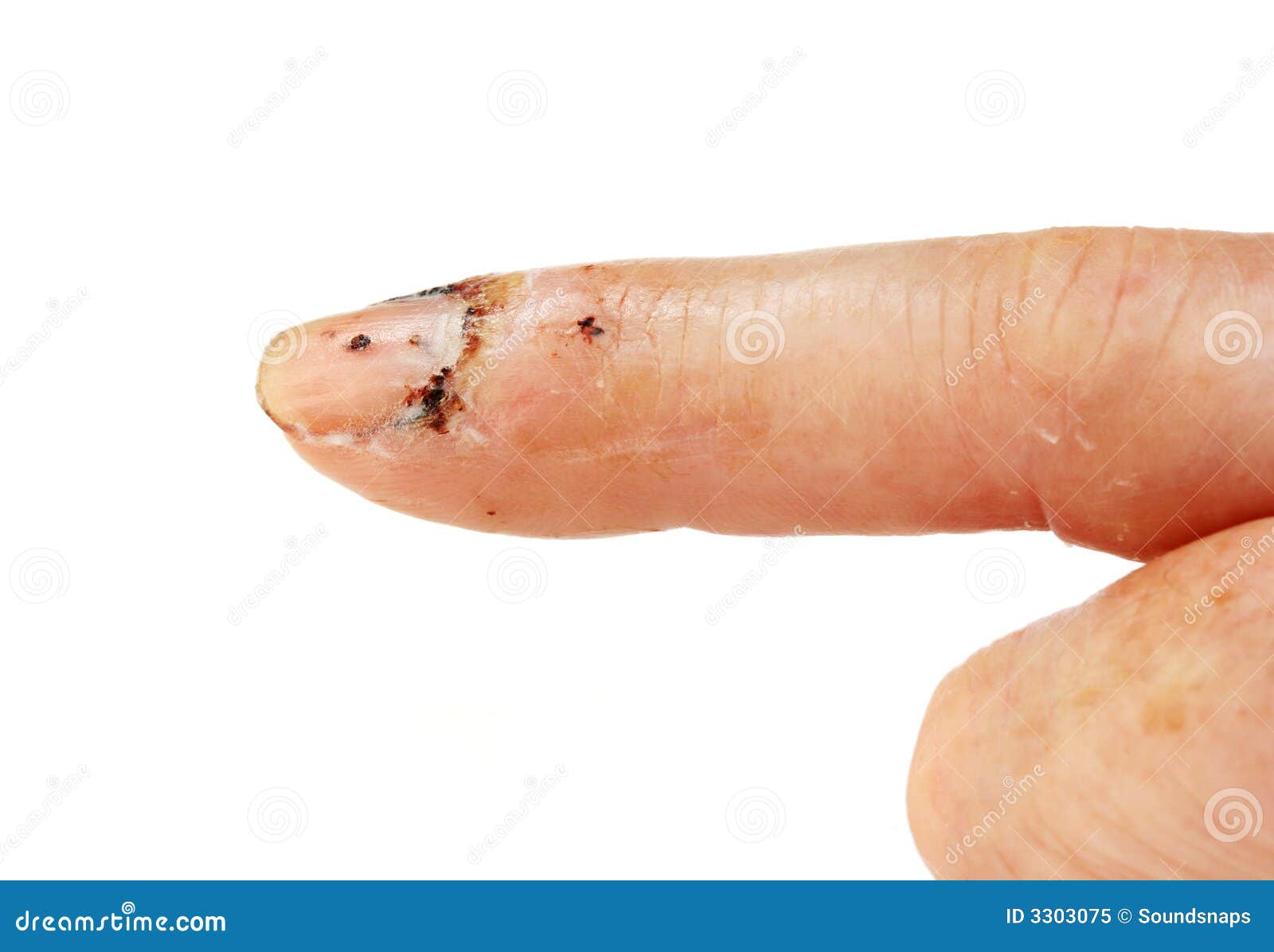 Injured Finger Close Up stock image. Image of phalanx - 3303075