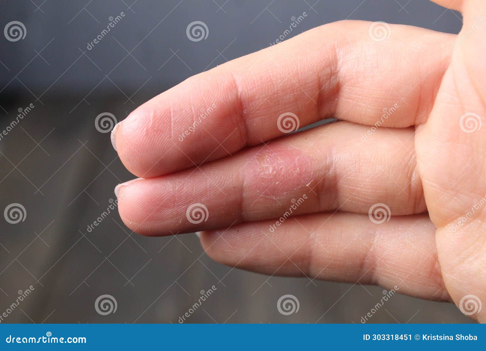 Injured Finger. a Mark of a Healed Wound on a Finger Stock Image ...