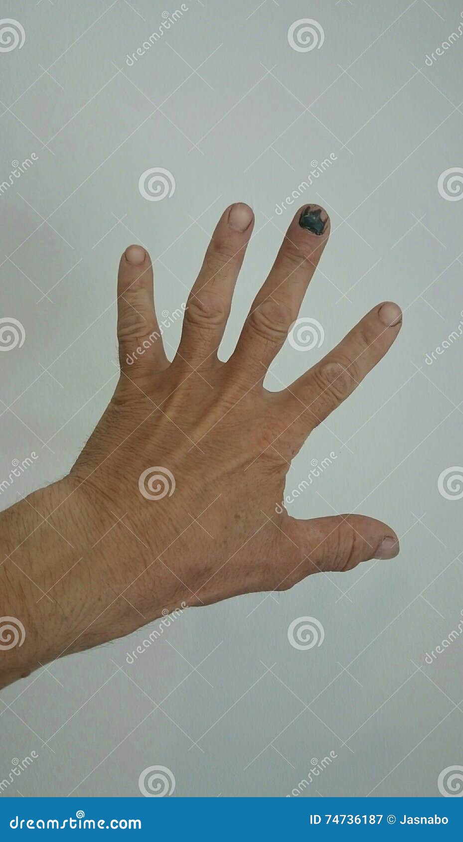 Injured finger stock image. Image of accident, medicals - 74736187