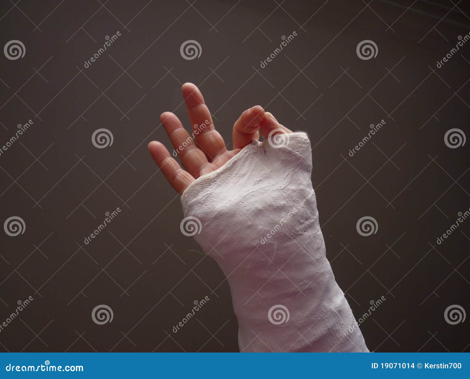 Injured hand with cast stock photo. Image of extremity - 19071014