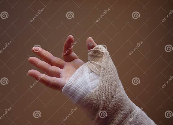 Injured hand with cast stock image. Image of thumb, scafoideum - 19077445
