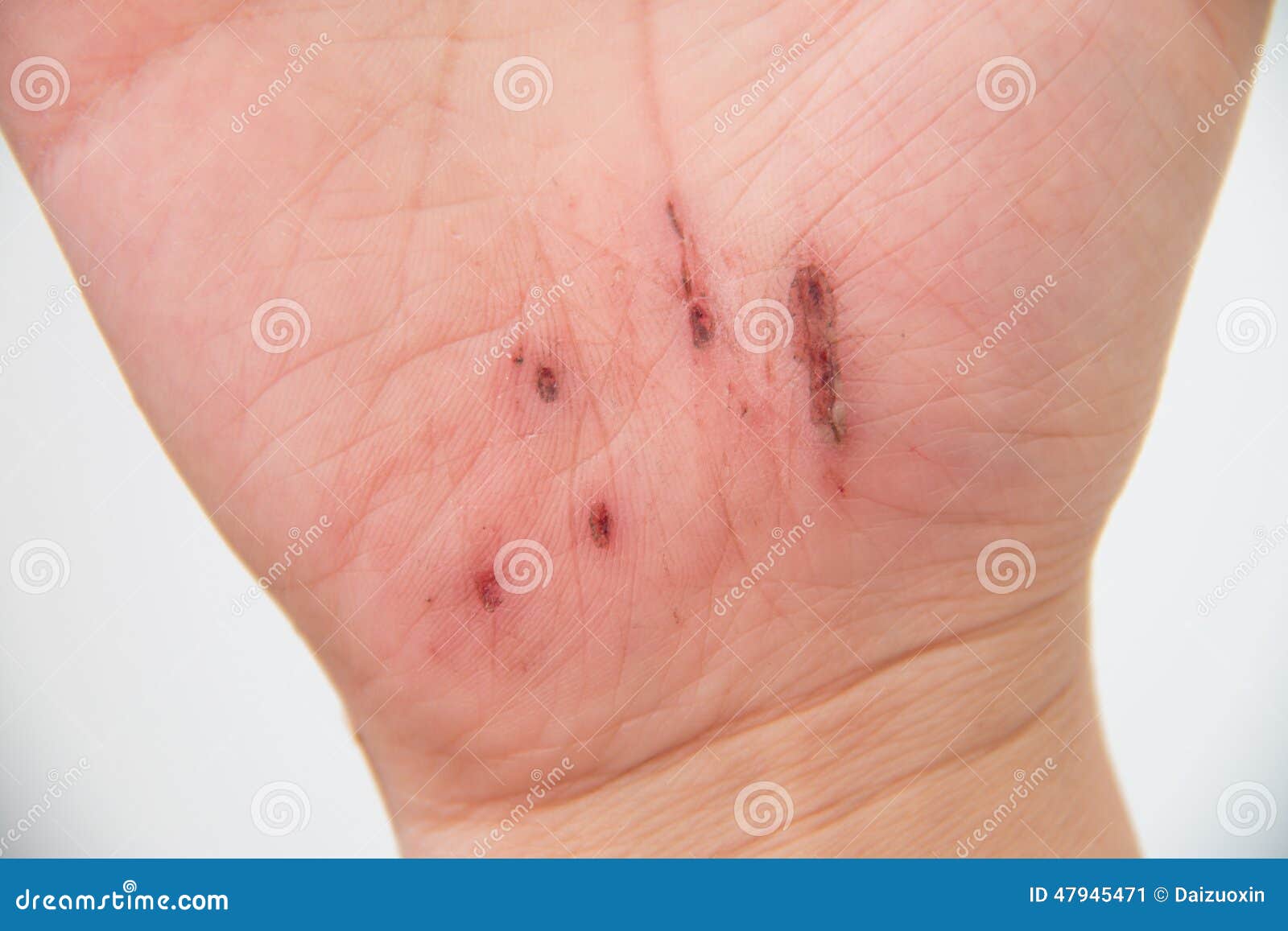 Injured hand stock image. Image of pain, asian, medicine - 47945471
