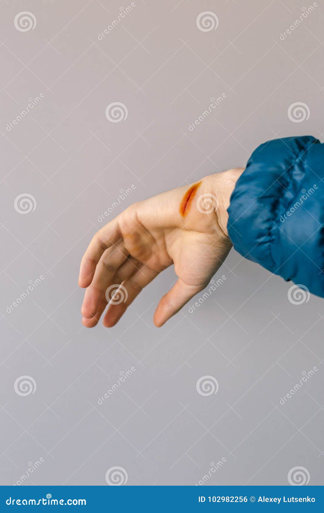 Injured Hand with Open Cut, Iodine-treated Stock Photo - Image of ...