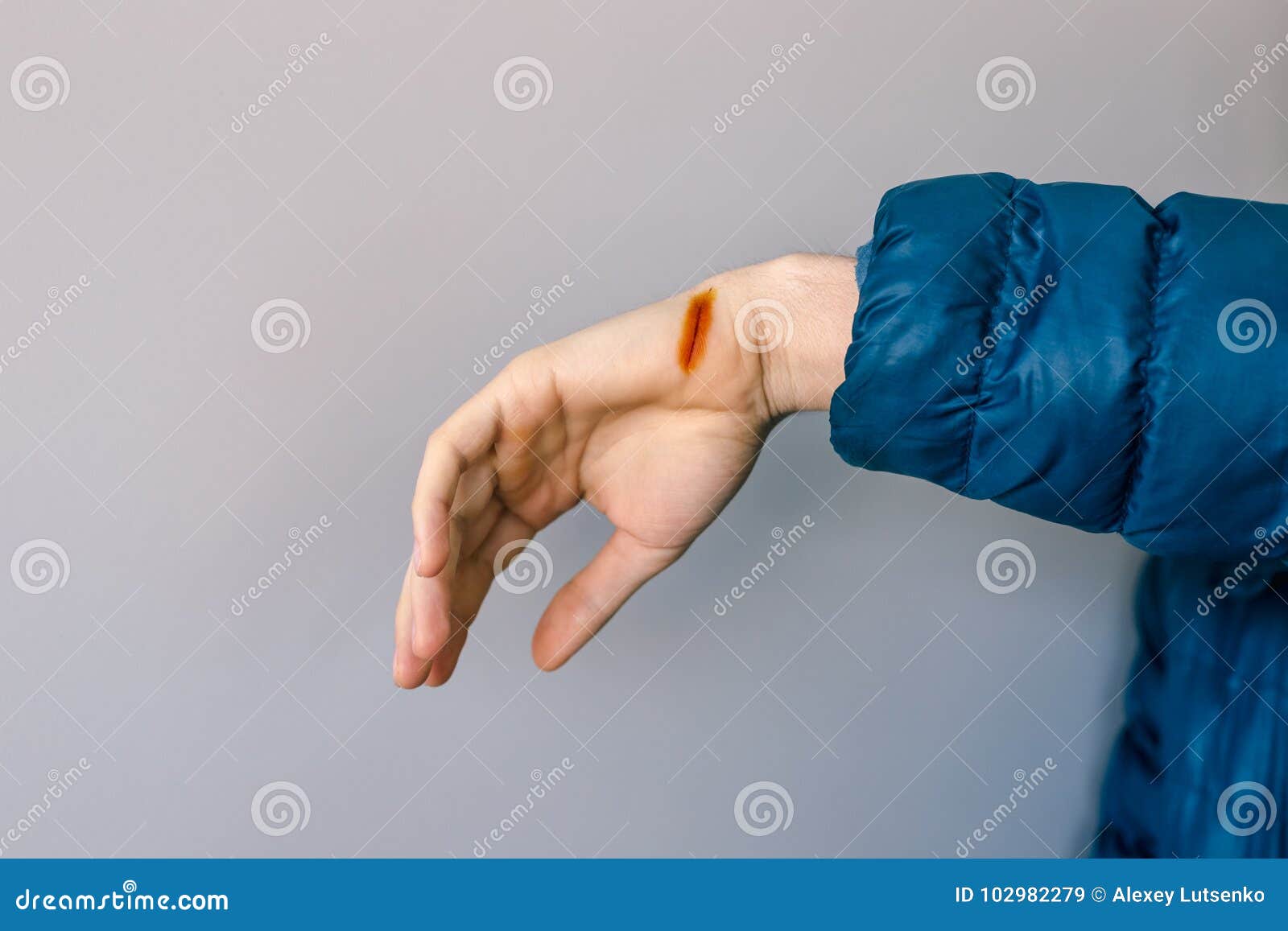 Injured Hand with Open Cut, Iodine-treated Stock Image - Image of ...