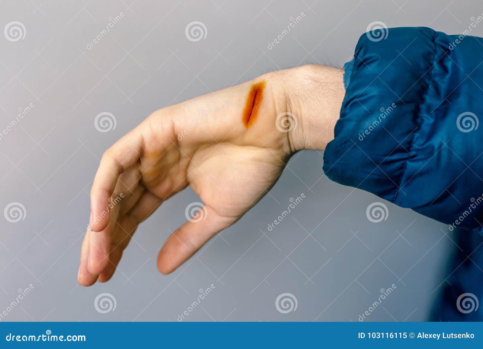 Injured Hand with Open Cut, Iodine-treated Stock Image - Image of hand ...