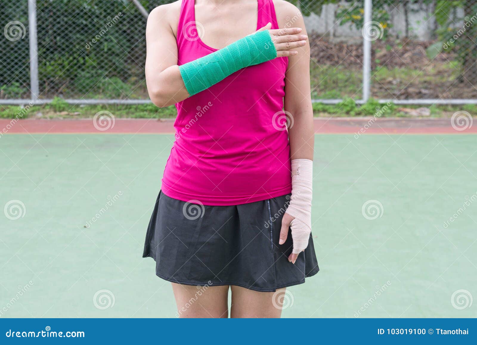 Injured Woman Broken on Arm with Arm Cast Standing on Floor Stock Photo ...