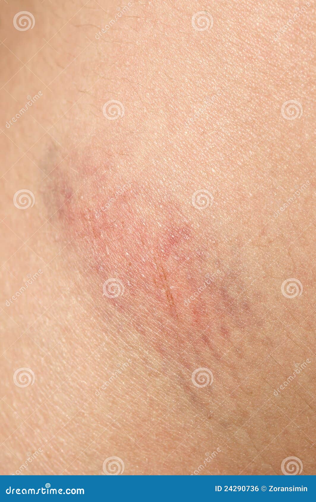 Injury stock photo. Image of scratched, human, caucasian - 24290736
