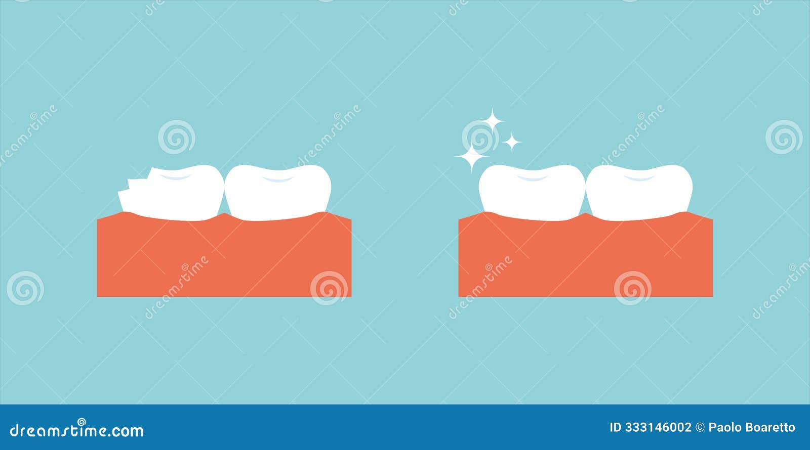 Fractured, Chipped Tooth In Cartoon Flat Style. Vector Illustration Of ...