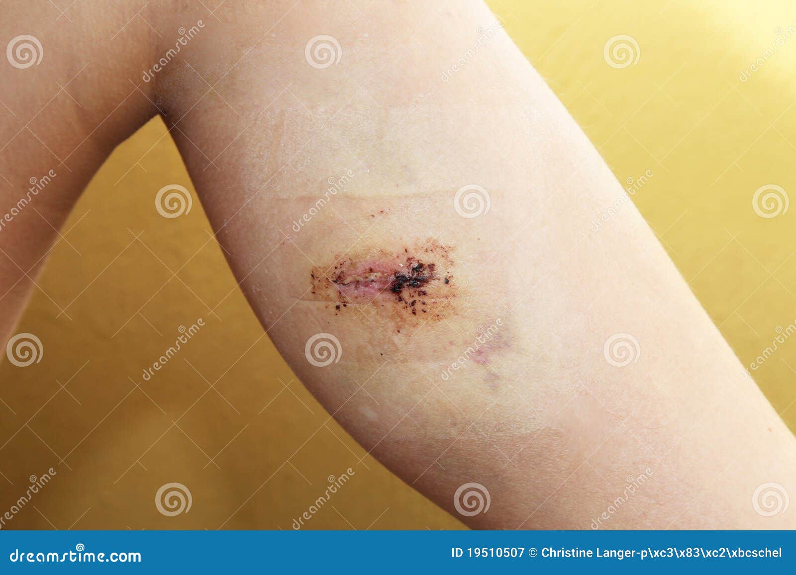 Injury To His Leg - Wound with Sutures Stock Image - Image of recovery ...