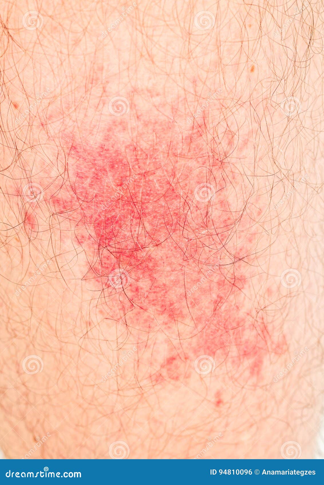Insect Bite stock photo. Image of bitten, sensitive, itchy - 94810096
