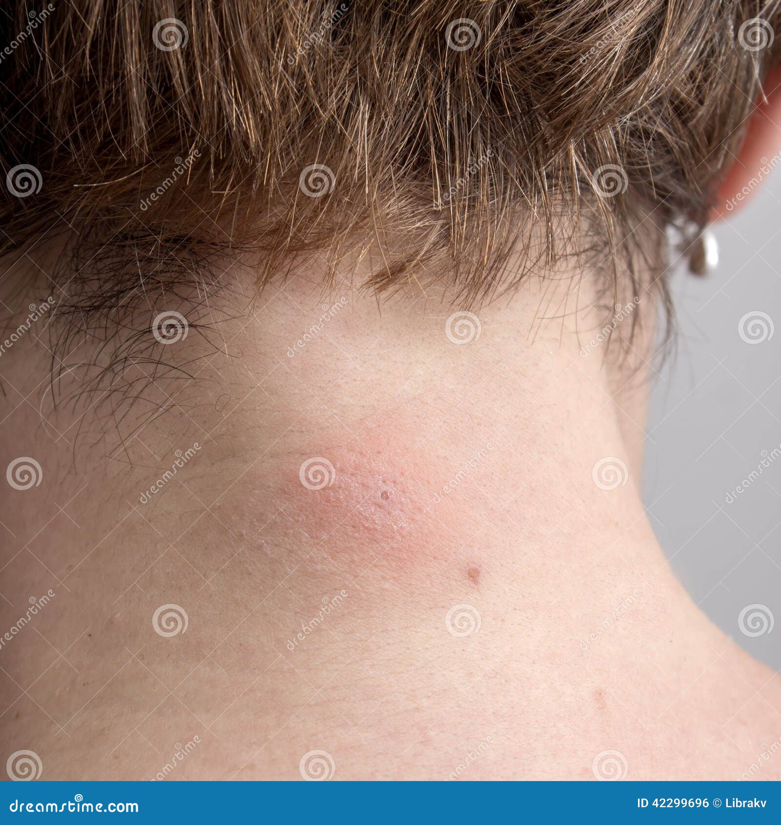 Insect Bite on Caucasian Skin Stock Photo - Image of scab, neck: 42299696