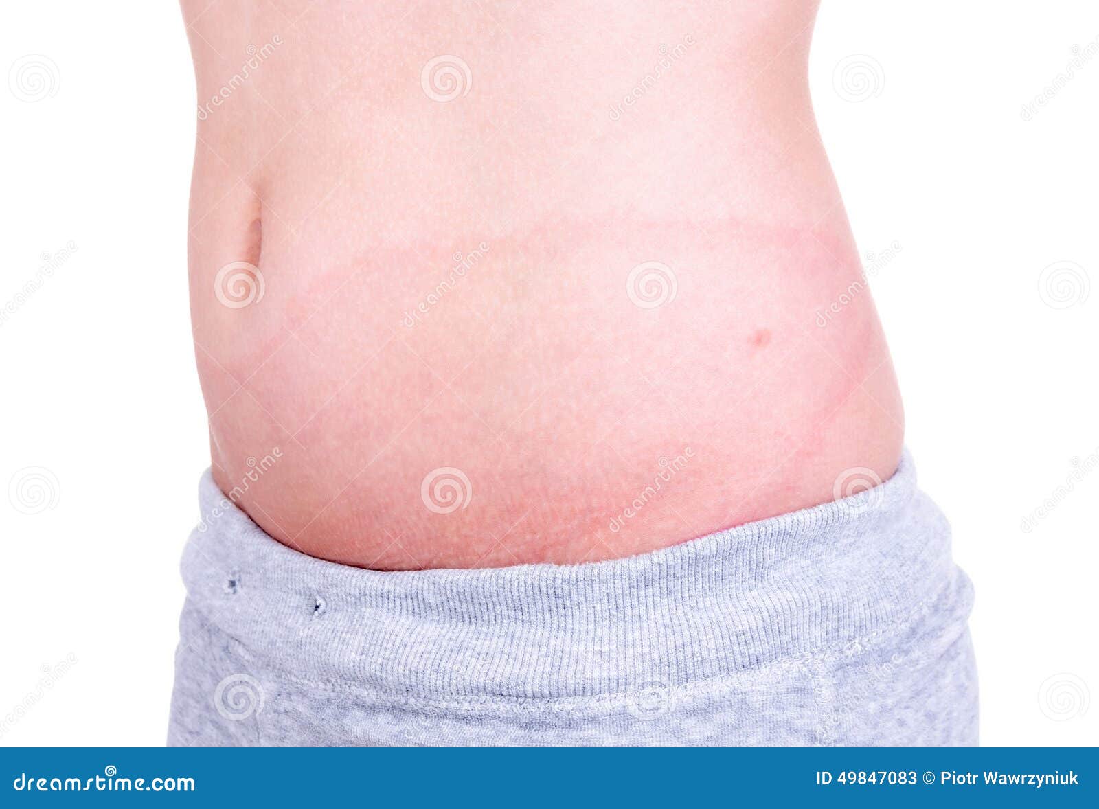 Insect bite infection stock image. Image of closeup, infectious - 49847083