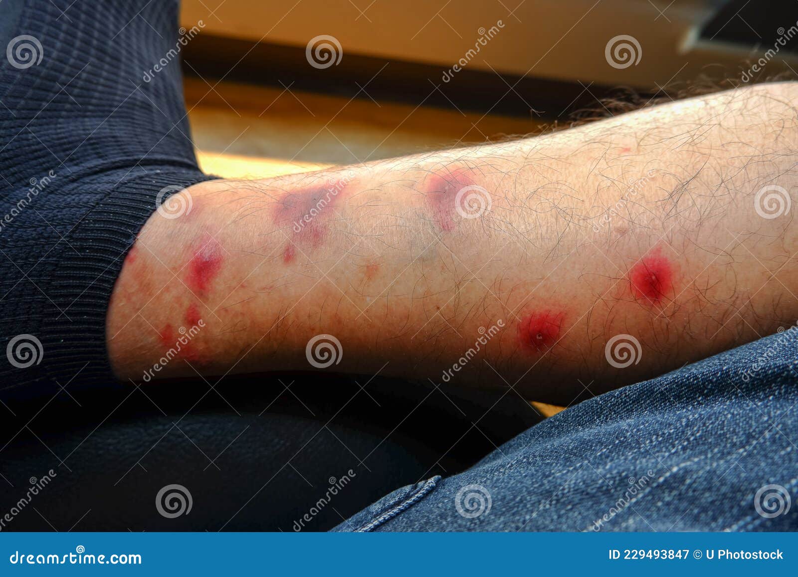 Insect bite of man leg stock image. Image of danger - 229493847