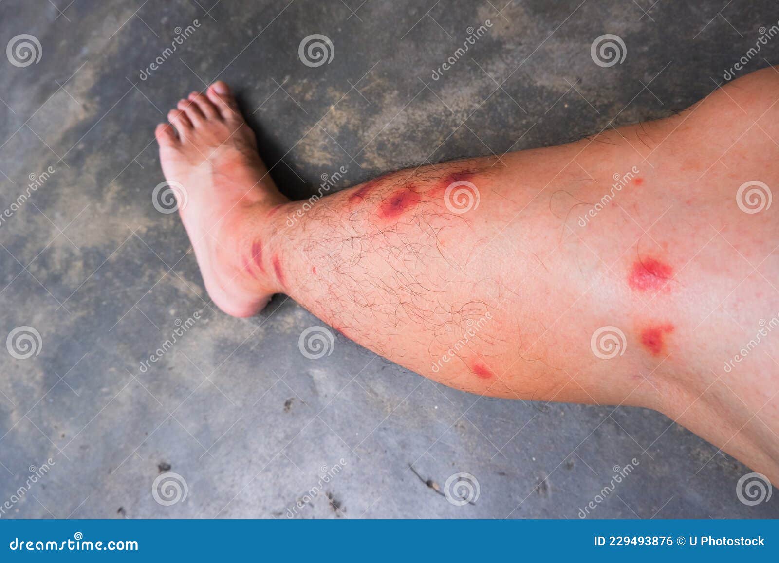 Insect bite of man leg stock photo. Image of human, medical - 229493876