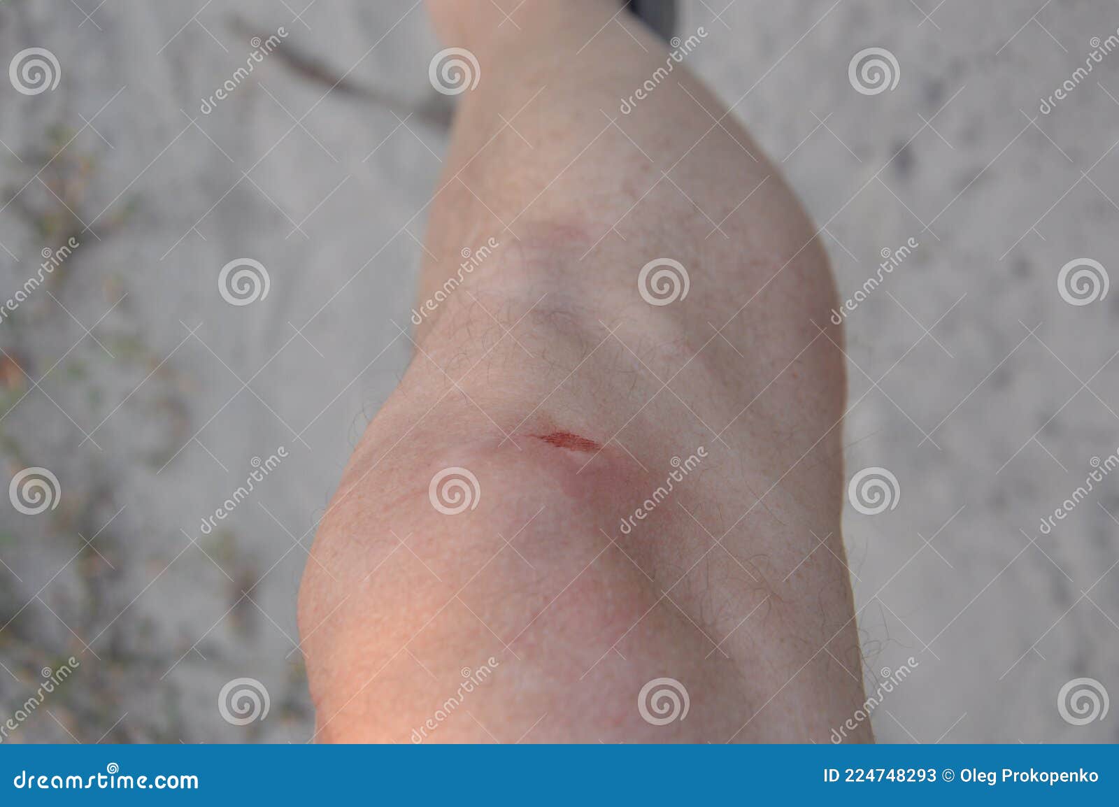 Insect Bite Wounds on Human Skin Stock Image - Image of dermatitis ...