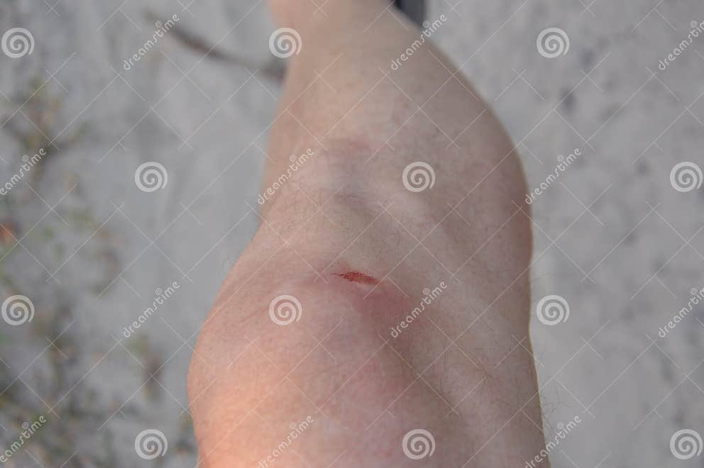 Insect Bite Wounds on Human Skin Stock Image - Image of dermatitis ...
