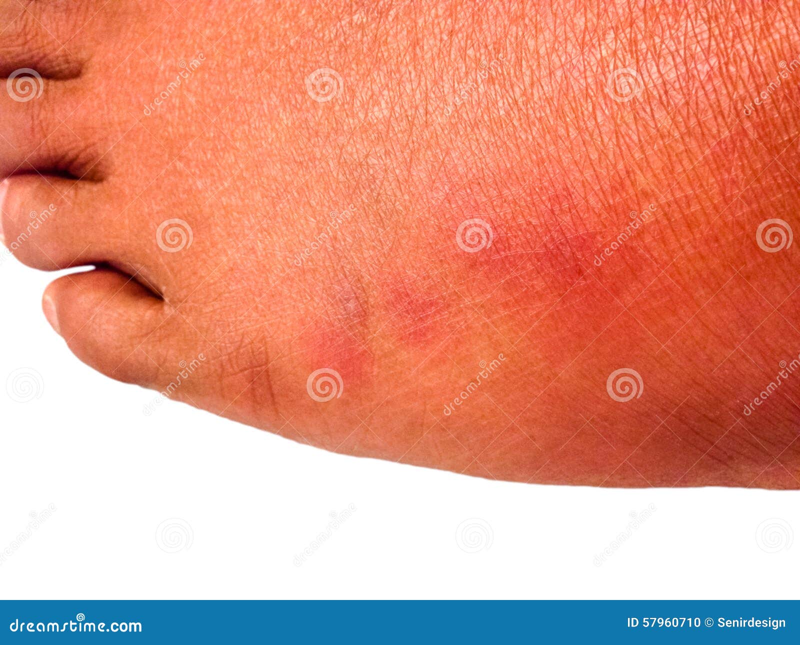 Insect Bites stock photo. Image of cimex, bloodsucker - 57960710