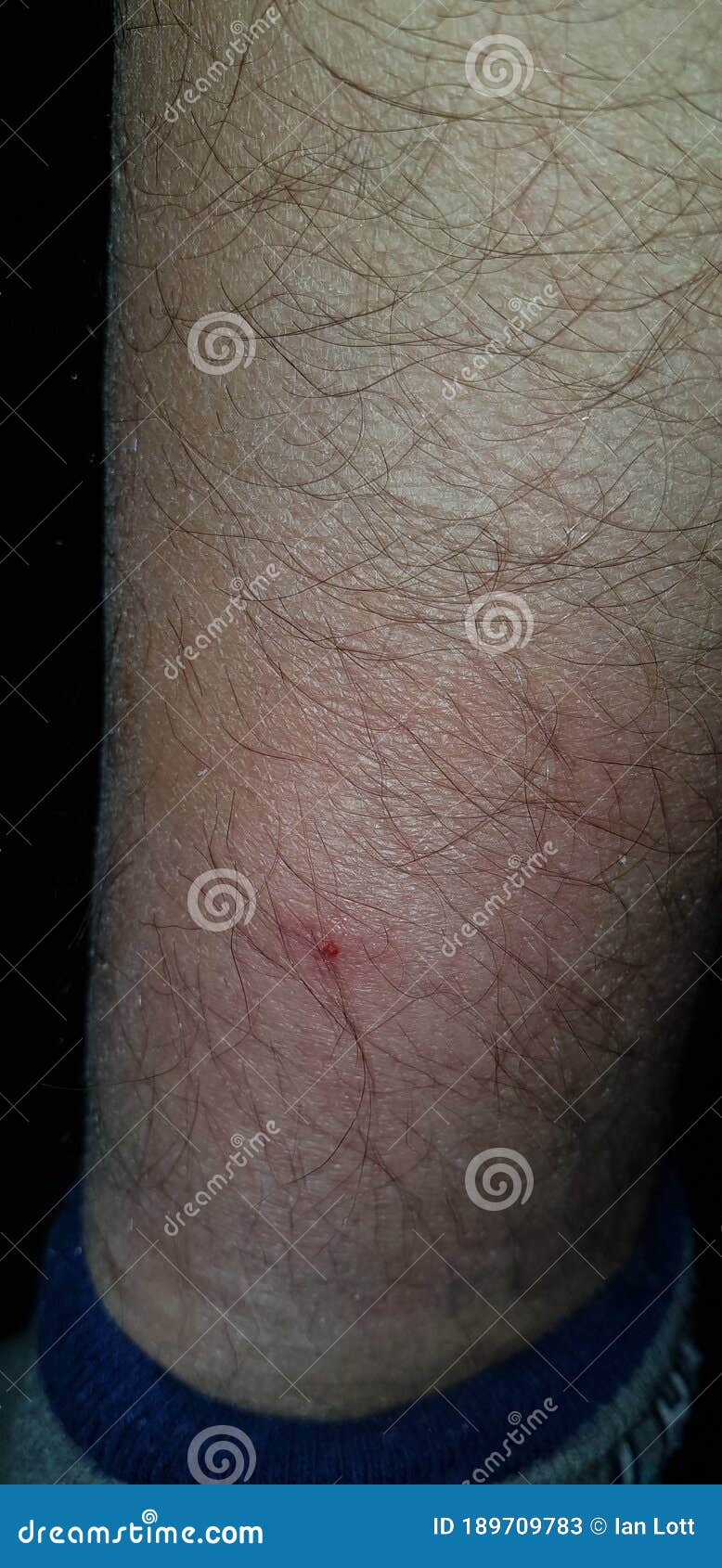 Insect bite on the leg stock image. Image of malaria - 189709783