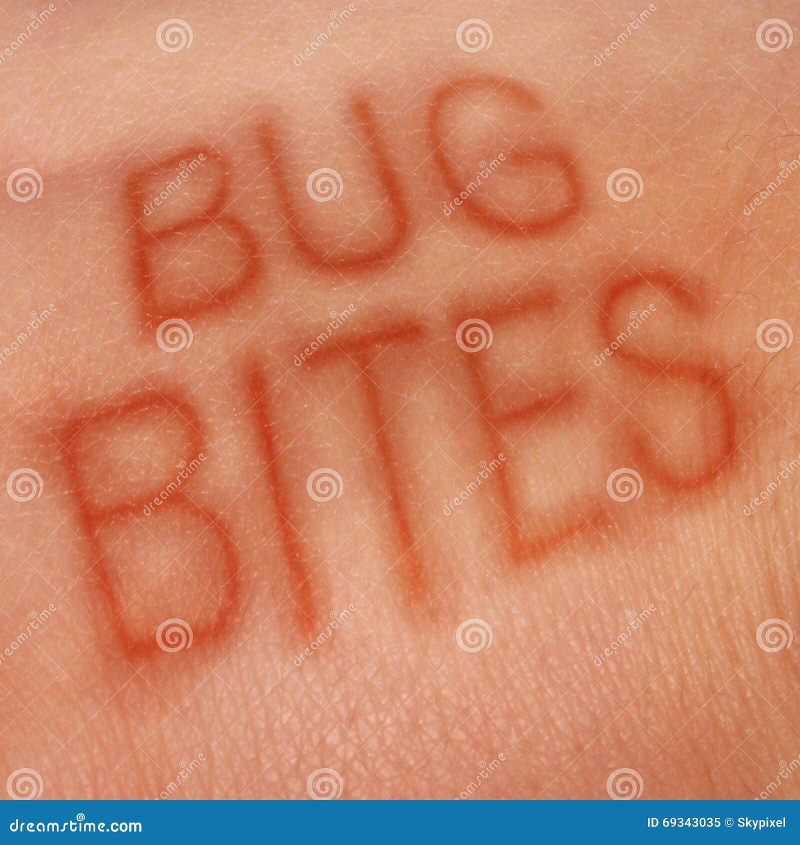 Insectenbeten stock illustratie. Illustration of zweren - 69343035