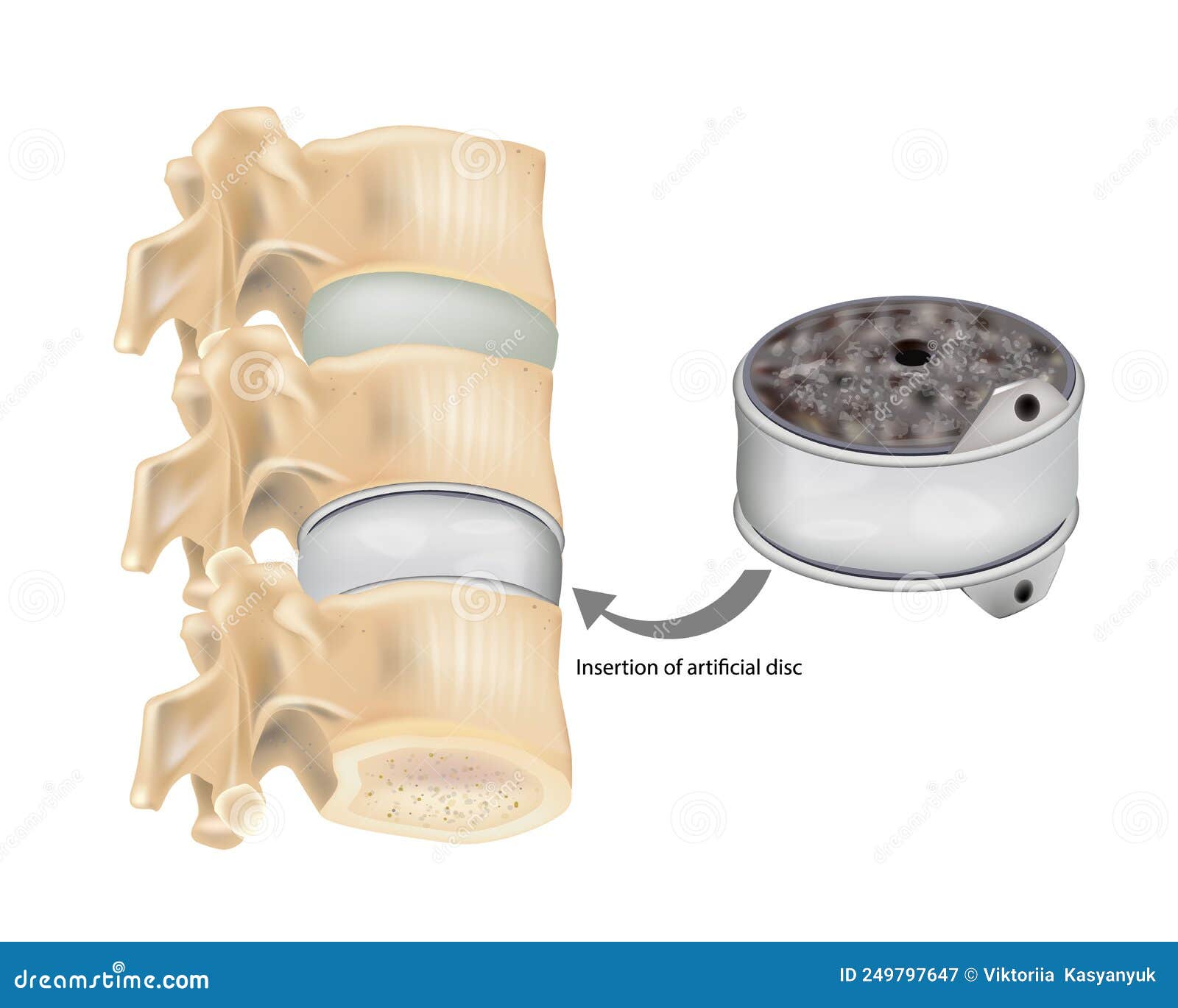 Lumbar Artificial Disc Replacement. Human Bone Anatomy. Royalty-Free ...