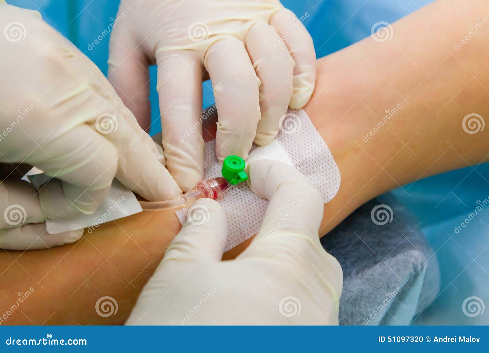 Insertion Veineuse Périphérique De Cathéter Photo stock - Image du ...