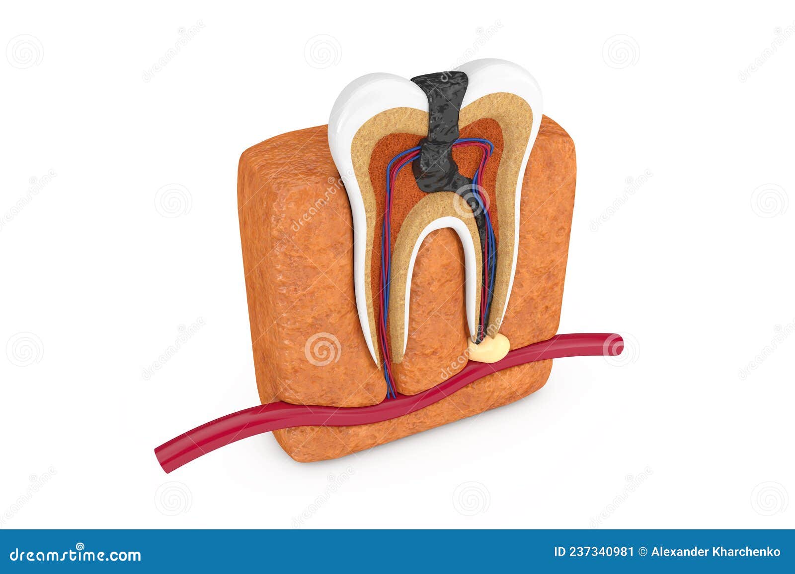 Inside of Decay Tooth. 3d Rendering Stock Illustration - Illustration ...