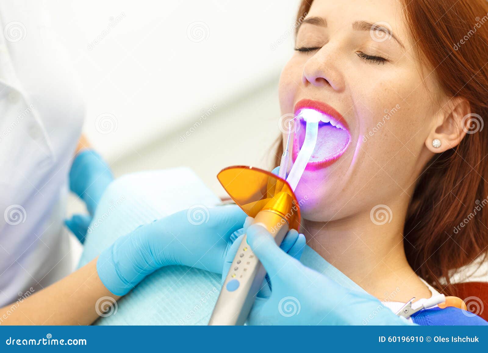 Installation of Light-curing Fillings Stock Photo - Image of examining ...