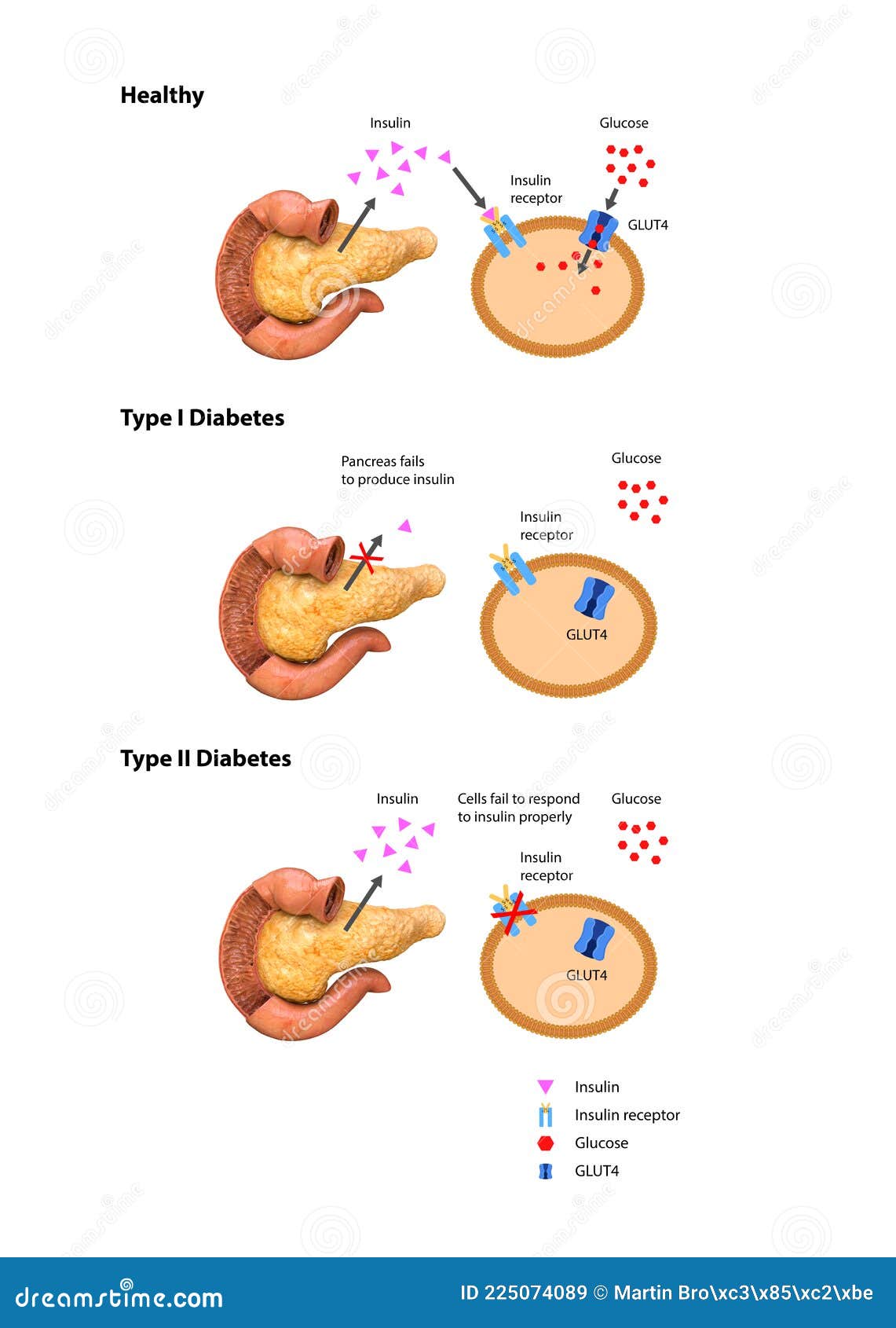 Insulin Type / Normal Physiology , Diabetes / Unlocks The Cell`s ...