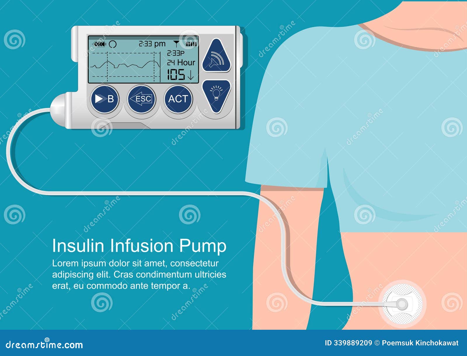 Insulin Infusion Pump is a Device Stock Illustration - Illustration of ...