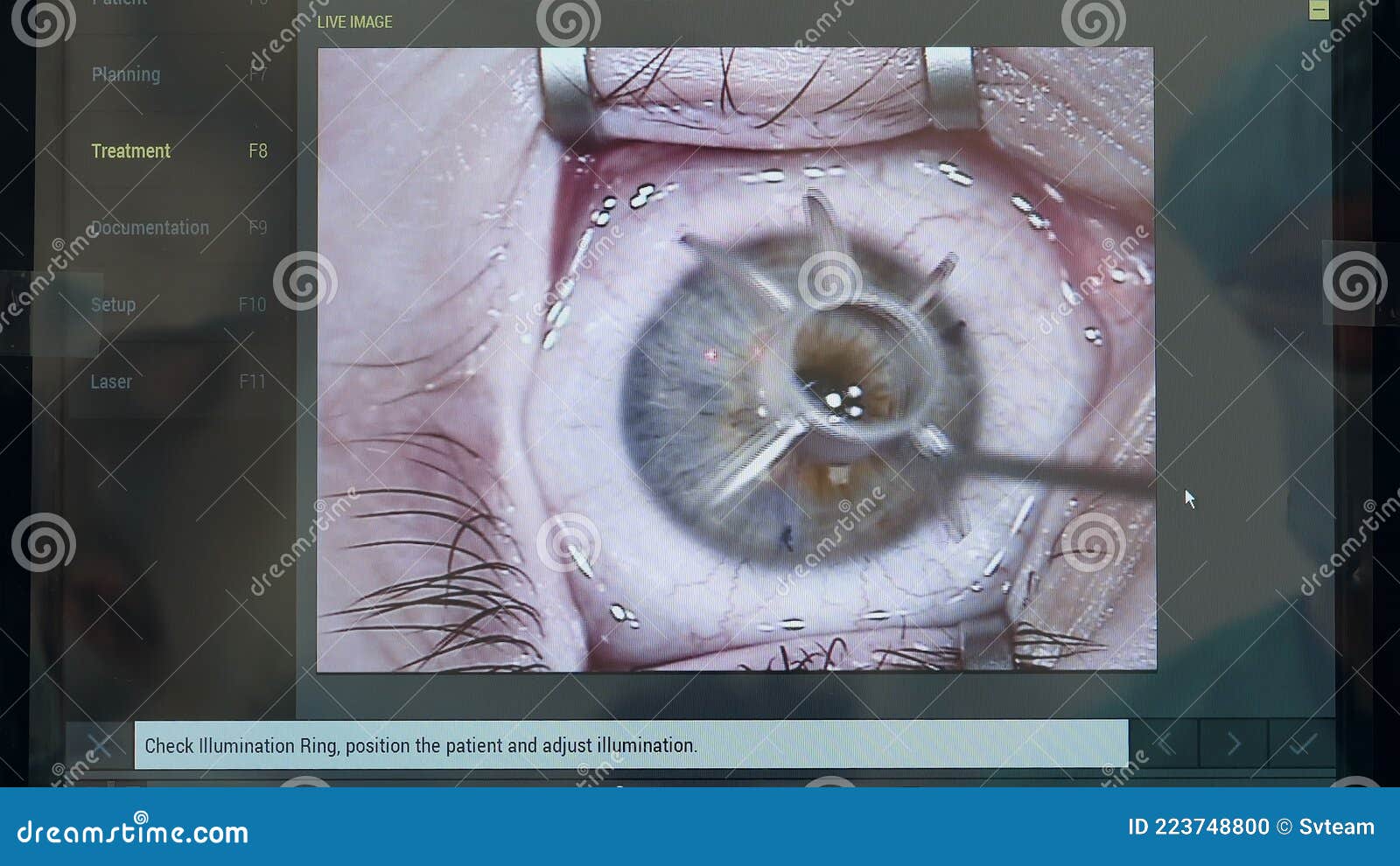 Interface of a Computer Program with Eye Surgery Shown in it Stock ...
