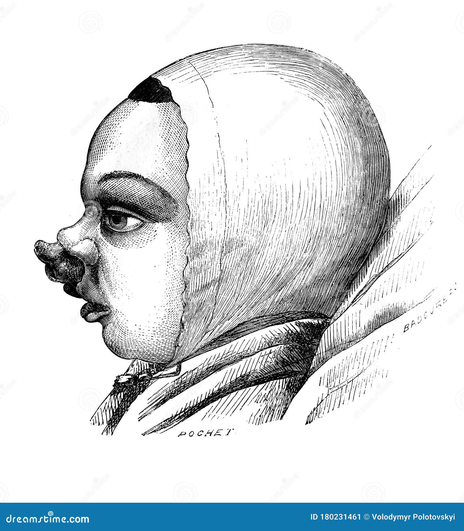 Intermaxillary Bone Projection, Insertion of the Middle Lobule of the ...