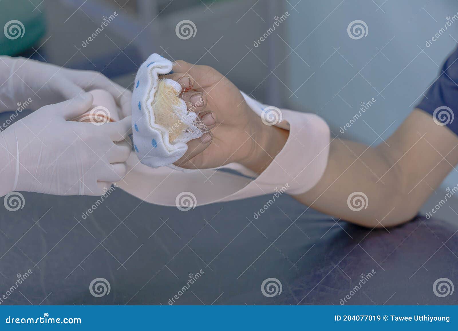 Internal Fixation of Finger Fractures Stock Image - Image of ...