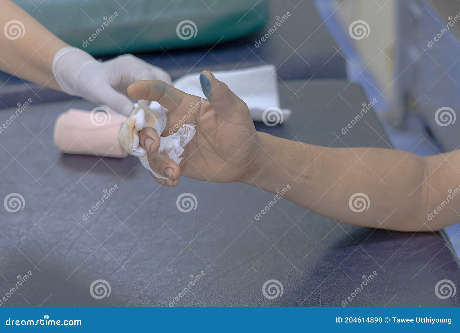Internal Fixation of Finger Fractures Stock Photo - Image of film ...