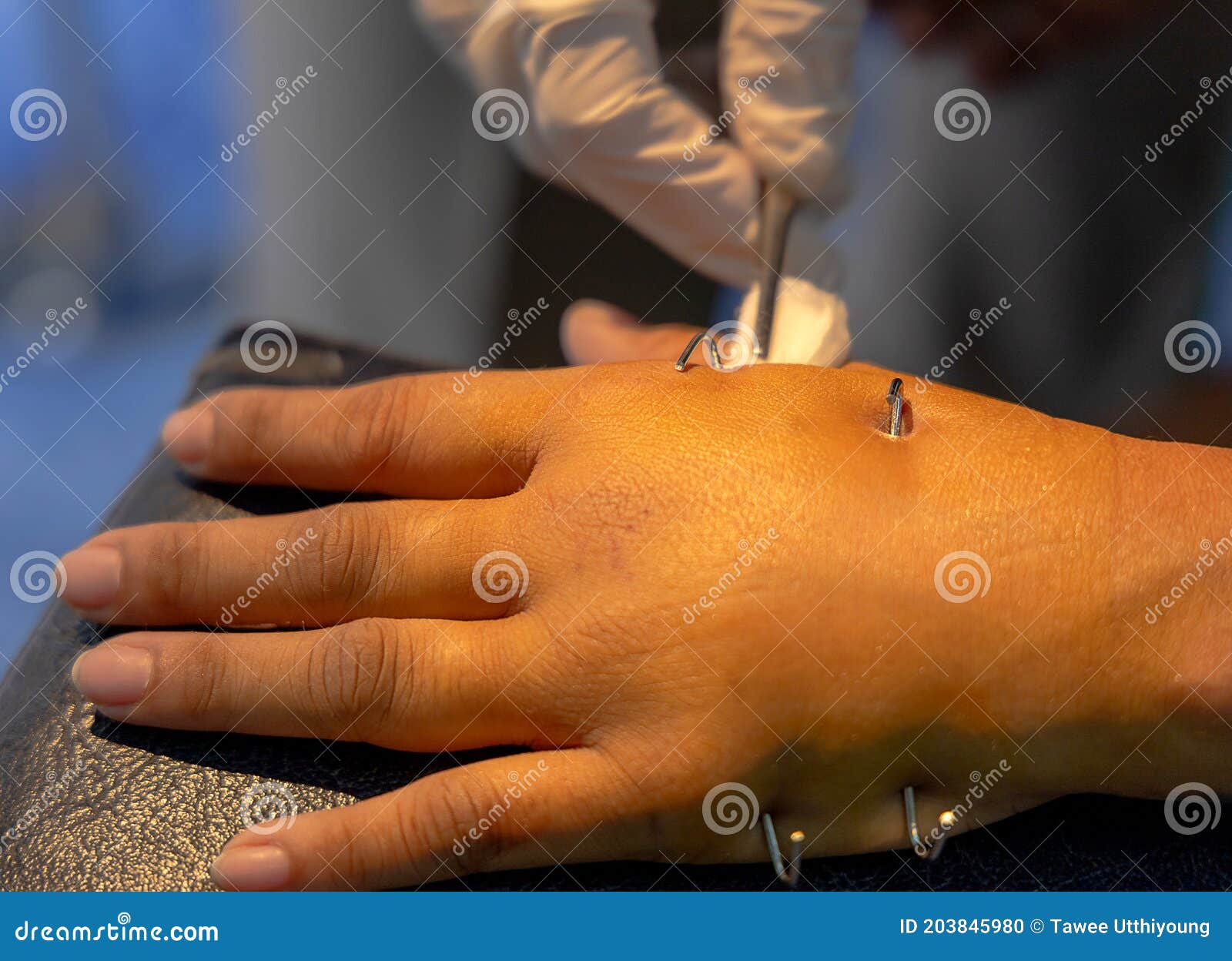 Internal Fixation of Hand Fractures Stock Photo - Image of hand ...