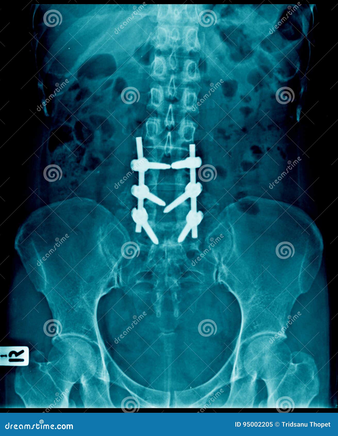 X-ray Internal Fixator Stock Photography | CartoonDealer.com #95002262