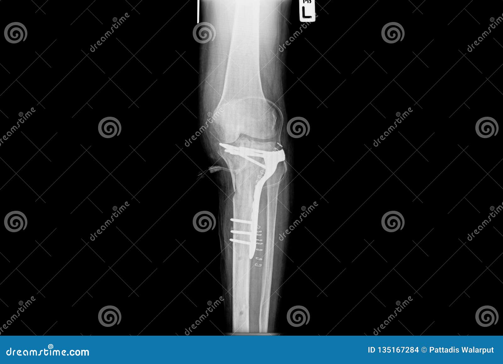 Internal of Left Leg Fixed with Plate and Screws Stock Photo - Image of ...