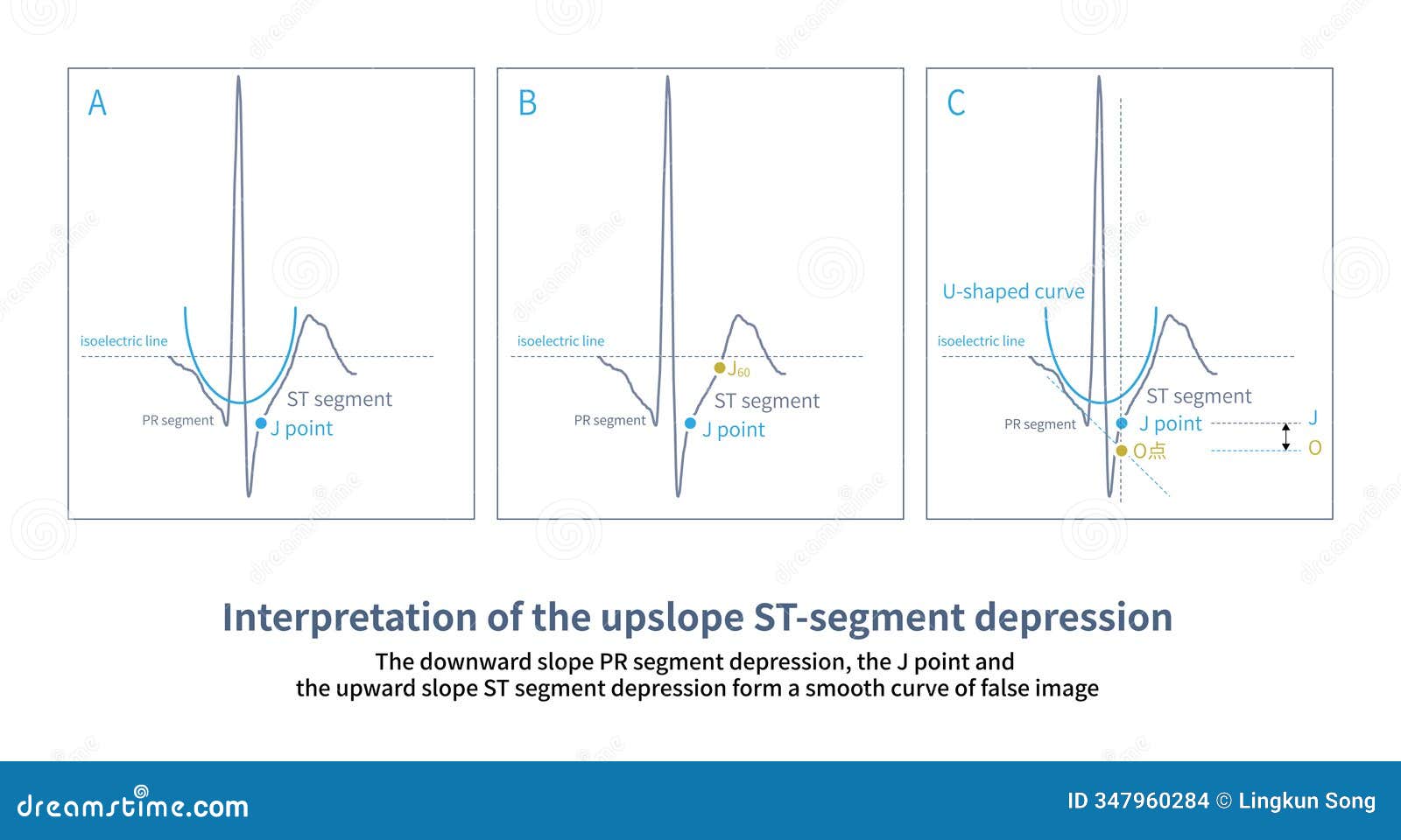 Interpretation of the Upslope ST-segment Depression Stock Illustration ...