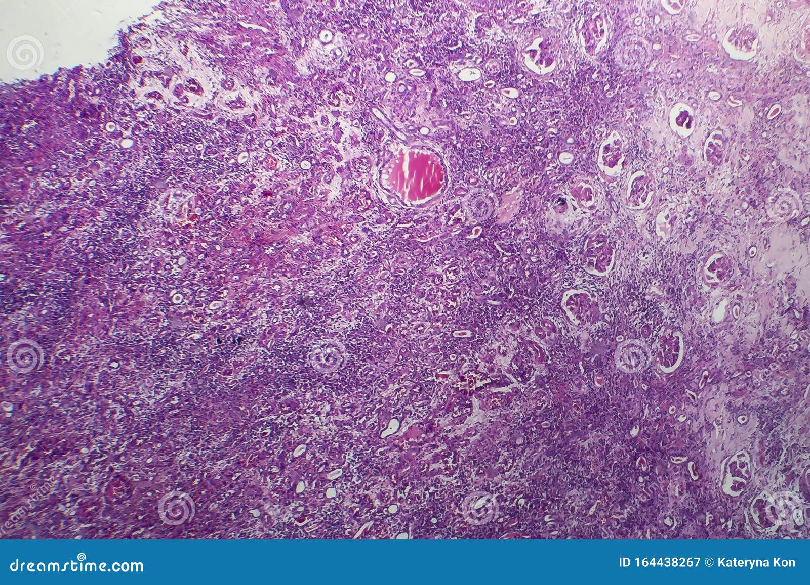 Interstitial Nephritis, Light Micrograph Stock Image - Image of tissue ...