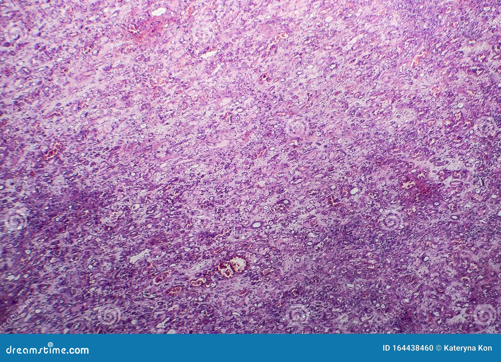 Interstitial Nephritis, Light Micrograph Stock Photo - Image of disease ...