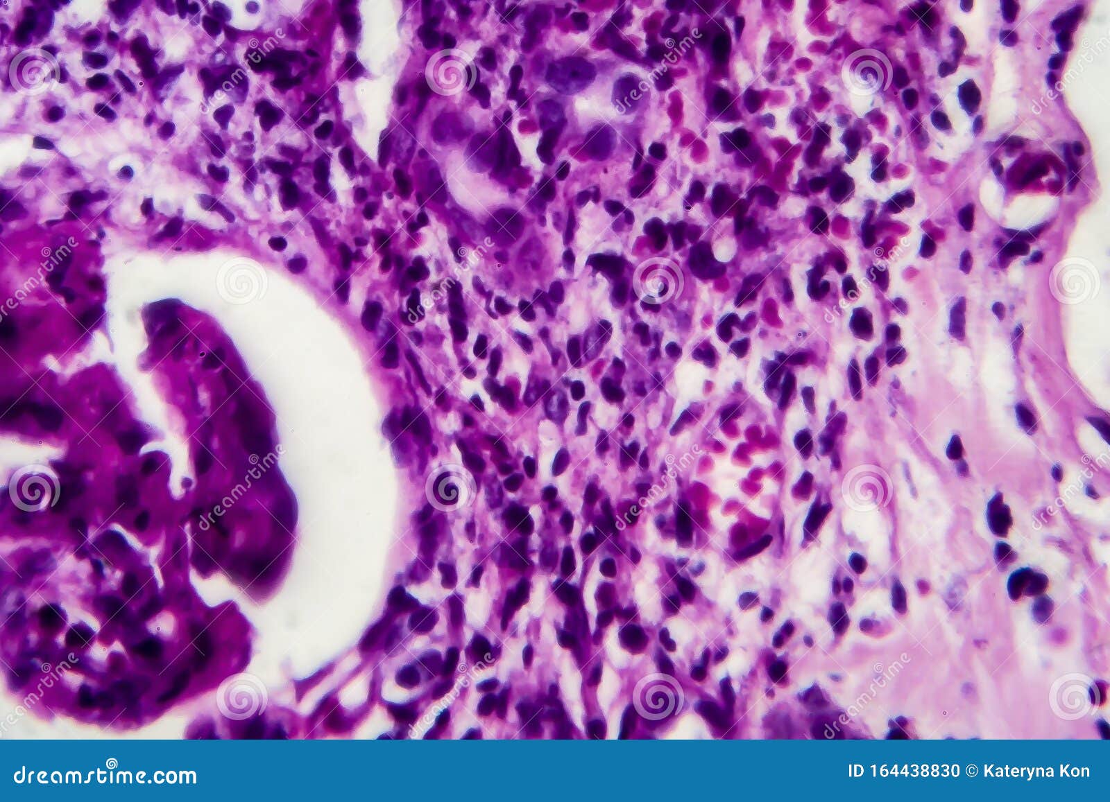 Interstitial Nephritis, Light Micrograph Stock Photo - Image of ...